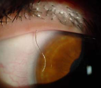 PREVENIR LA CEGUERA: PARPADOS: ENFERMEDADES