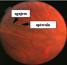 PREVENIR LA CEGUERA: DESGARROS Y AGUJEROS DE RETINA...