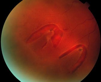 PREVENIR LA CEGUERA: ROTURAS DE LA RETINA Y SU TRATAMIENTO...