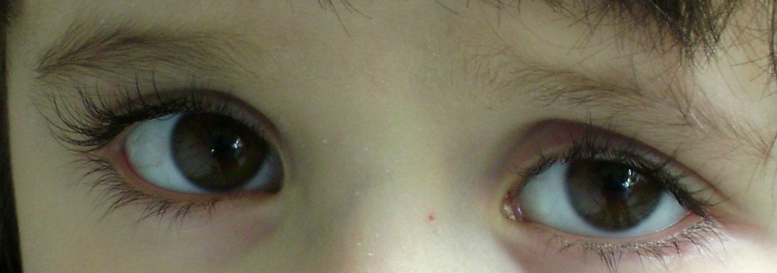 PREVENIR LA CEGUERA: EVALUACION OPTOMETRICA EN NIÑOS...