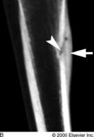 Life & Science: Bone Fractures!!!