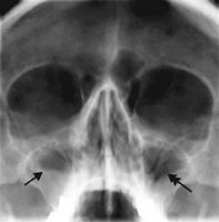 Otorrinolaringología Infantil