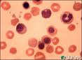 life science: ERYTHROBLASTOSIS FETALIS