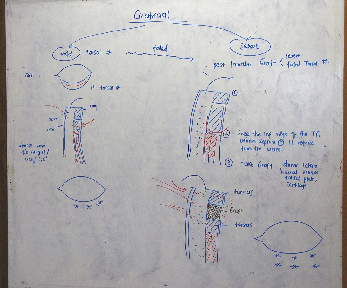 UKM Ophthal Part 2 2010: Entropion