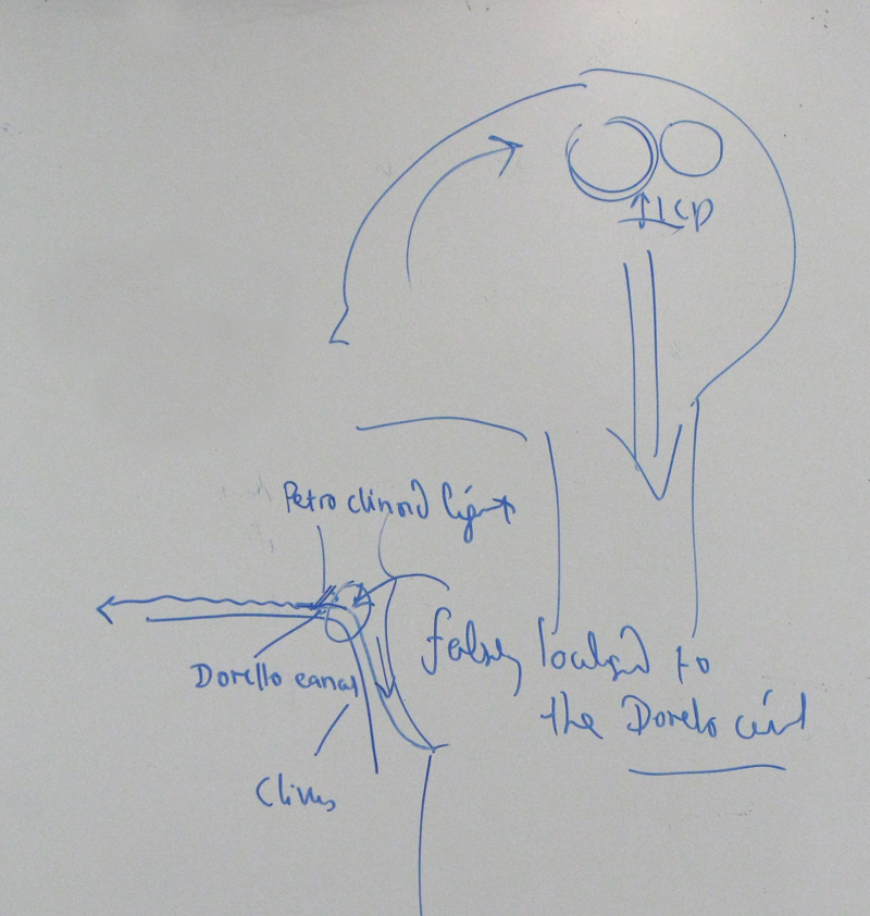 UKM Ophthal Part 2 2010: CN6 palsy: false localising sign