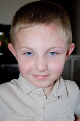 The Moments We Share: skeeter syndrome