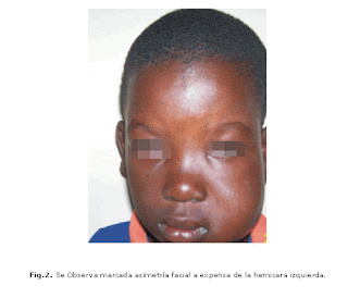 Epidemiologia Escobar: CARBUNCO (ANTRAX) - Lo que debe saber ...