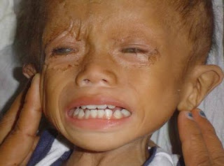 Epidemiologia Escobar: Tracoma una de las enfermedades olvidadas ...