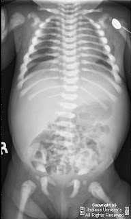 Orthopaedic Surgery CME: X-ray of te day: Osteopetrosis