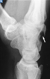 Orthopaedic Surgery CME: X-ray of the day: Fracture-dislocation of the ...