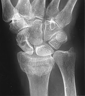 Orthopaedic Surgery CME: X-ray of the day: Colles' fracture