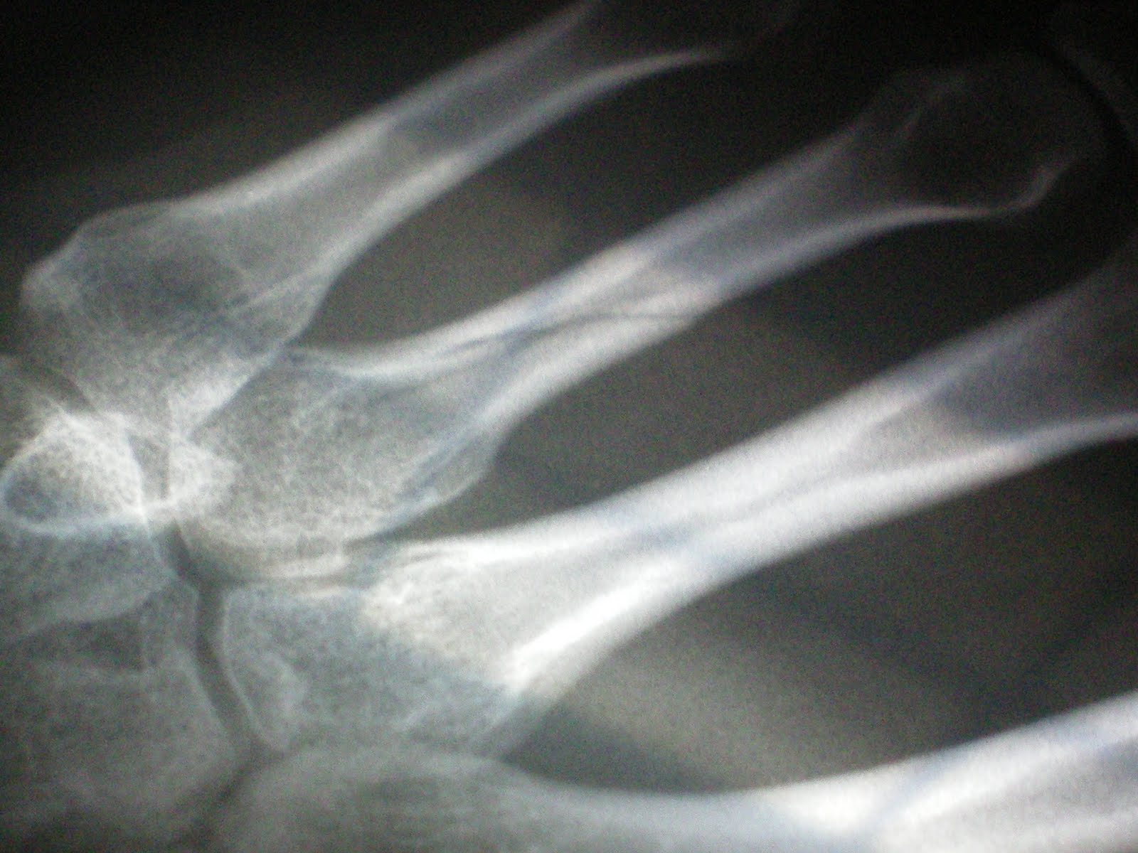 Bites, Boo-Boos, And Broken Boards: The Dangers Of Faking Injuries In ...