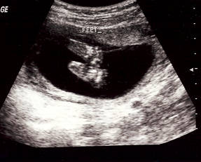 The Stewarts: Ultrasound