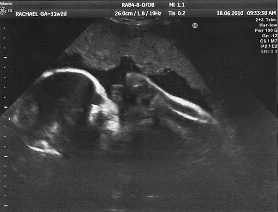 Bellytastic: 32 week scan