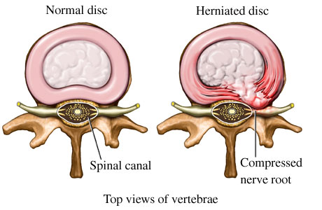 Schaffnit Chiropractic and Rehabilitation: Disc Herniation and ...