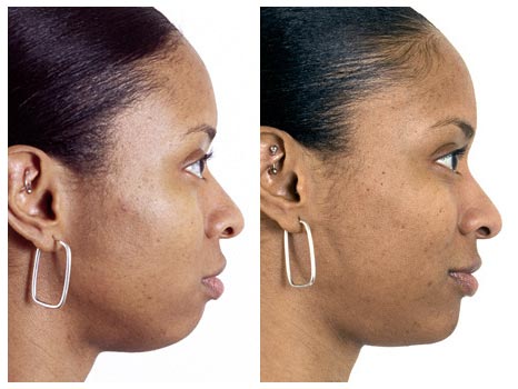 Plastic Surgery Before And After: Chin Implant Before And After