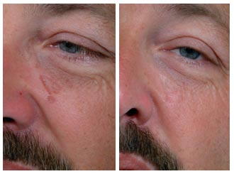 Plastic Surgery Before And After: Scar Revision Before And After