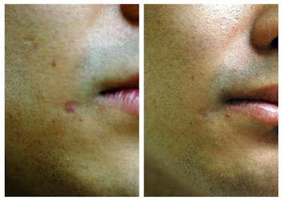 Plastic Surgery Before And After: Scar Removal Before And After