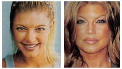 Plastic Surgery Before And After: Fergie Plastic Surgery