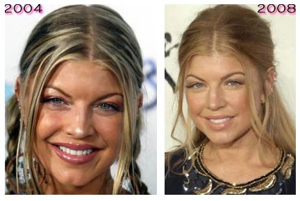 Plastic Surgery Before And After: Fergie Plastic Surgery