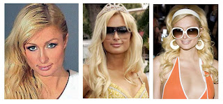 Plastic Surgery Before And After: Paris Hilton Plastic Surgery