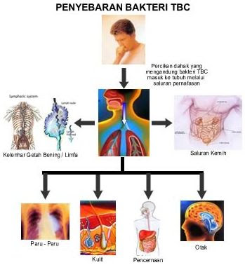 Tuberkulosis Ekstra Paru, TBC Extra Pulmonal Medical Articles
