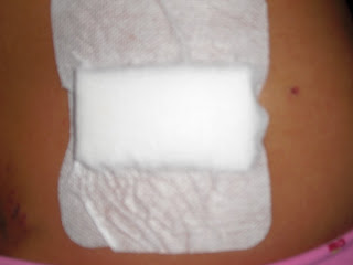 Interstim Anyone?: Satuday - Wednesday's update. and Stage 2