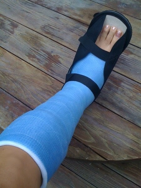 Plantar Fasciitis Cast