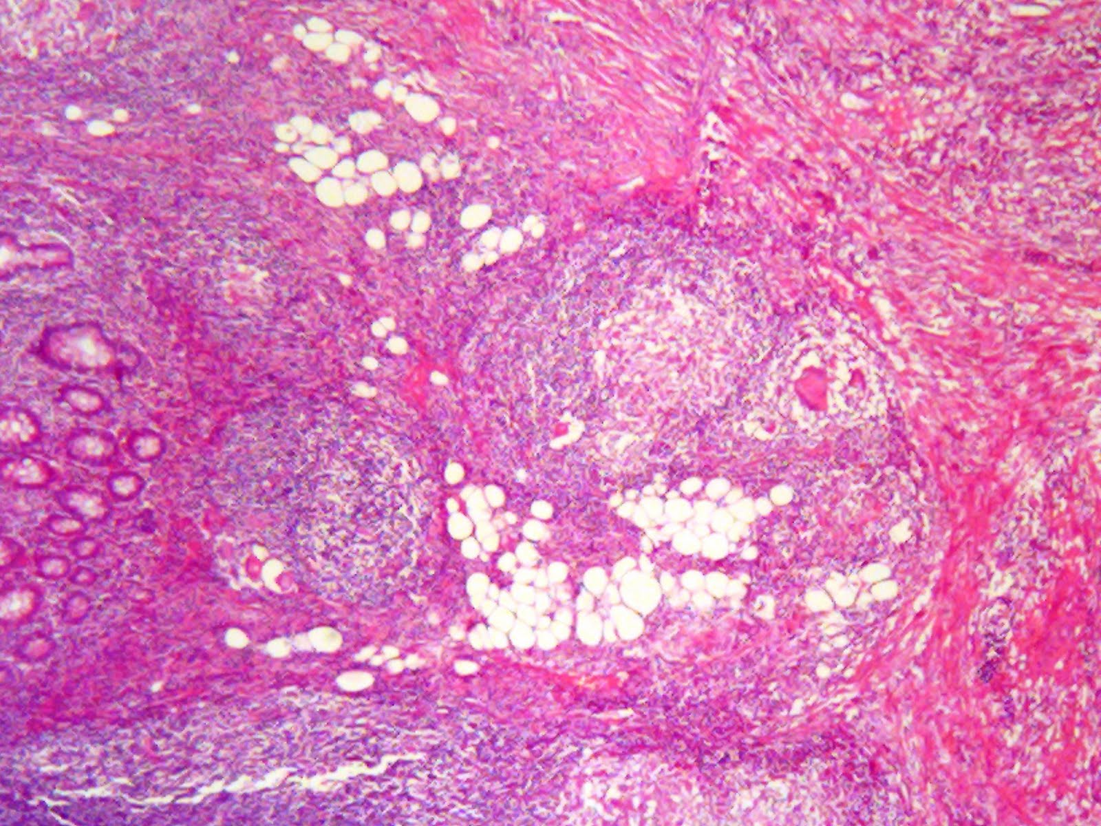 HISTOPATHOLOGY: Caecal Mass