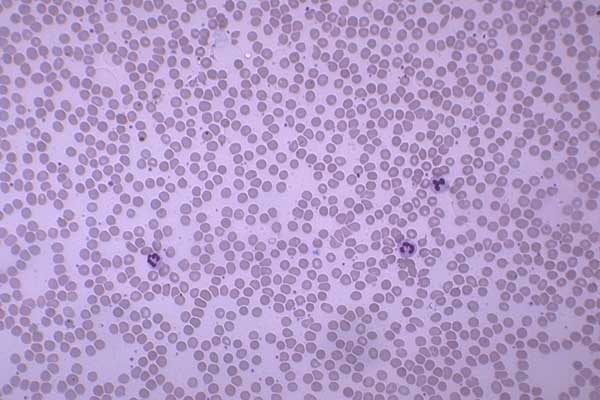 conteúdo hemoglobínico dos eritrócitos a eritrócitos normocrômicos são ...