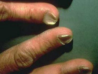 Esqueci Meu Esteto!: Imagem da Semana - Coiloníquia