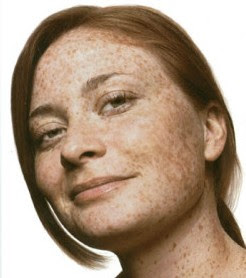 Pulse-Light Clinic cleared up my excessive freckling