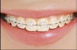 Hanson Place Orthodontics: Brooklyn NY Braces Means Options!