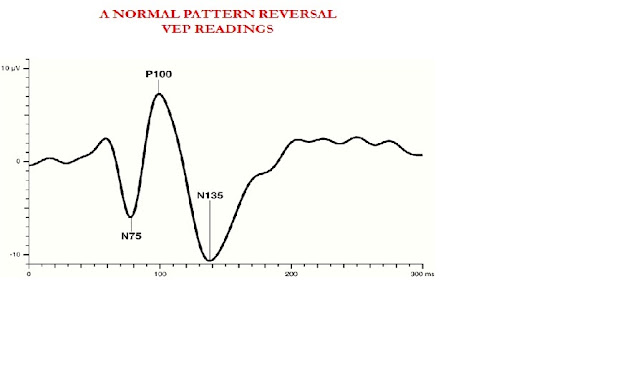 svep testing for amblyopia detection in infants: Technical overview