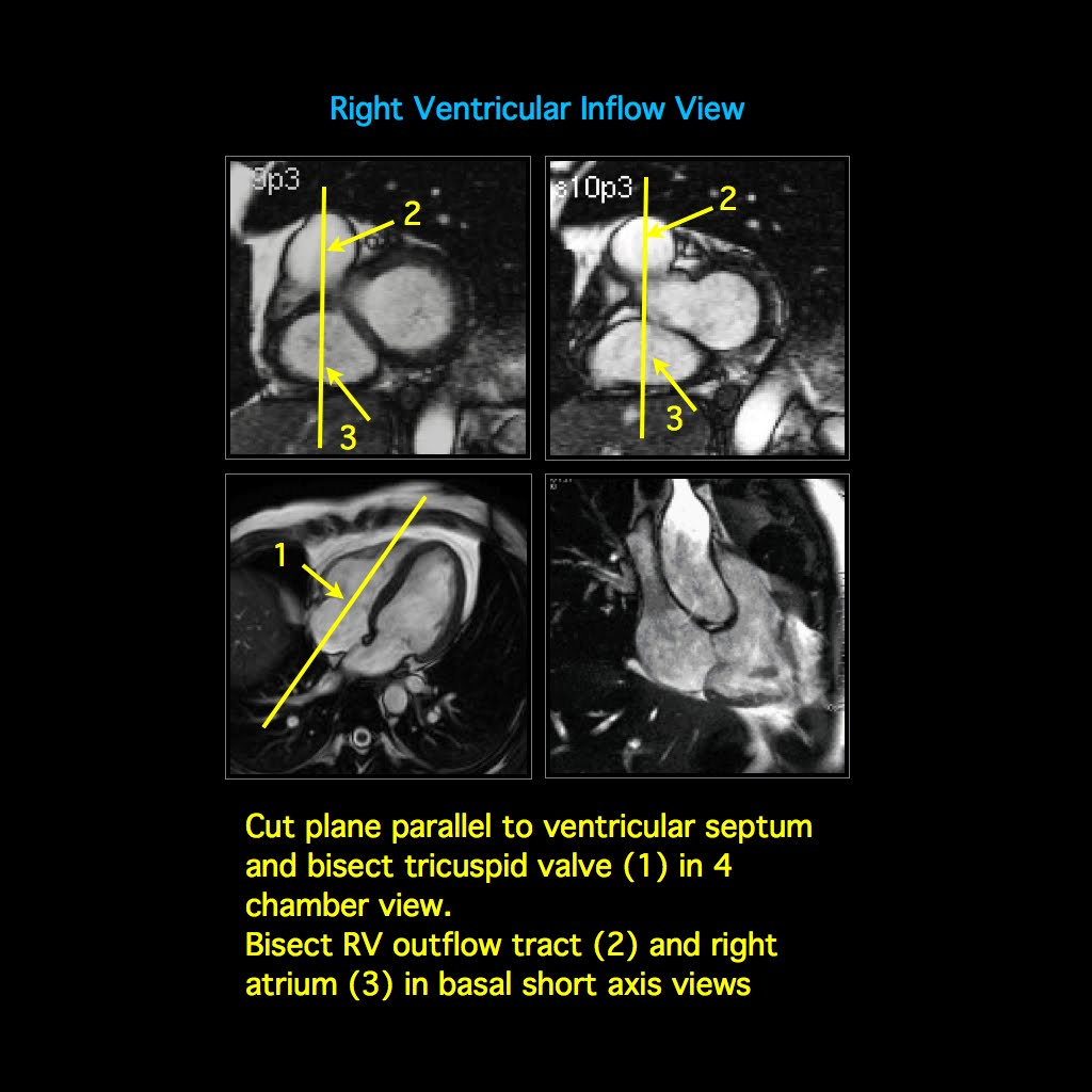 MRI BLOG: Cardiac MRI - Imaging Planes for Basic Cardiac Views