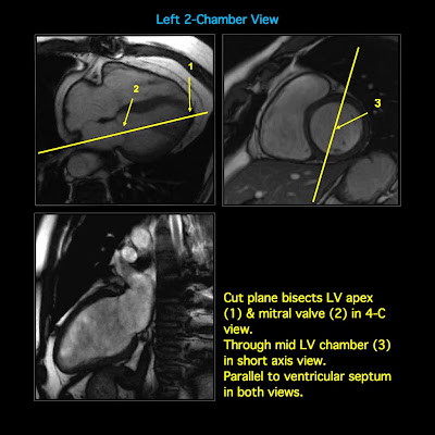 MRI BLOG: Cardiac MRI - Imaging Planes for Basic Cardiac Views