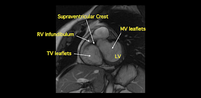 MRI BLOG: Cardiac Anatomy