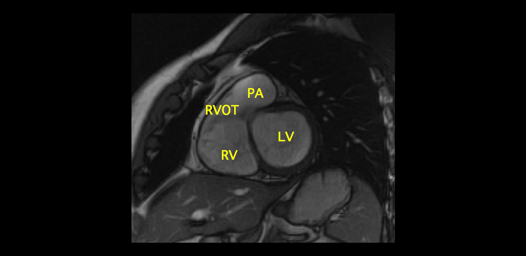 MRI BLOG: Cardiac Anatomy