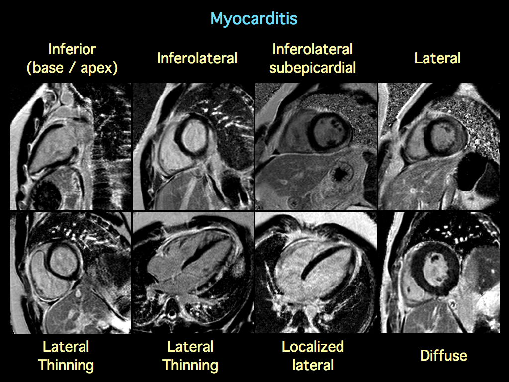 MRI BLOG: Imagery of Cardiac Pathology