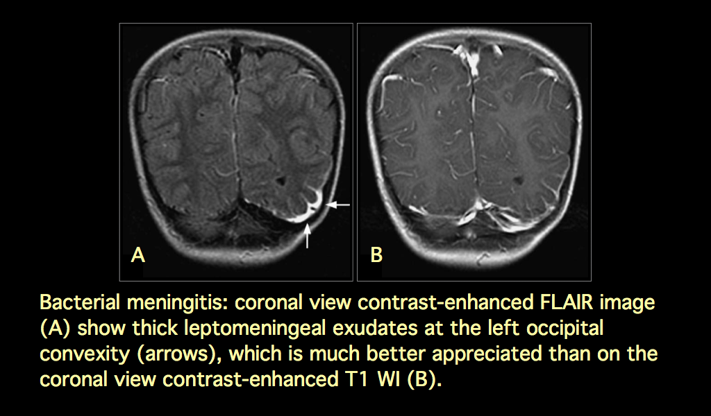 MRI BLOG: Contrast-enhanced FLAIR for Infectious Leptomeningitis