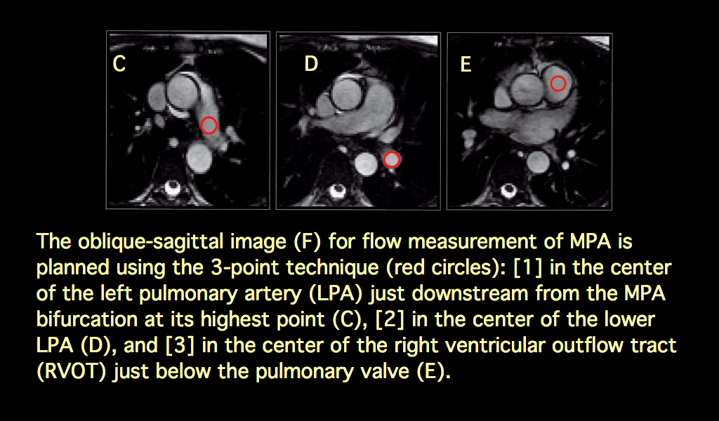 MRI BLOG: Flow Measurement in Main Pulmonary Artery