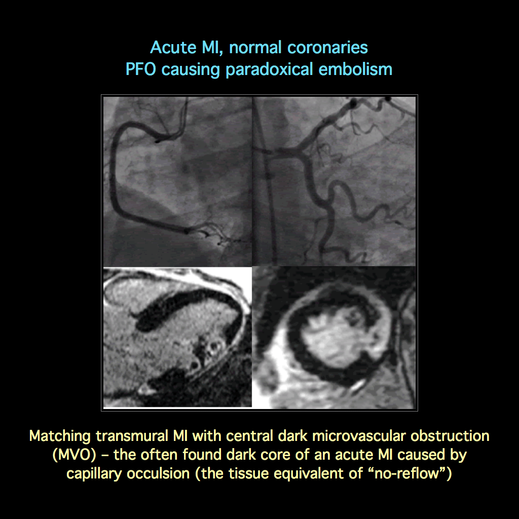 MRI BLOG: Imagery of Cardiac Pathology