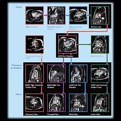 MRI BLOG: Cardiac MRI - Quick Guide to Imaging planes