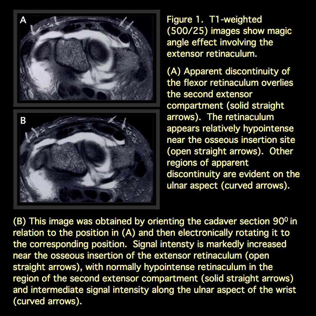 MRI BLOG: Magic Angle Phenomenon