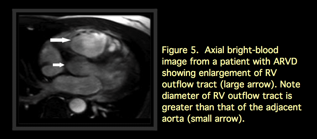 MRI BLOG: Arrhythmogenic Right Ventricular Dysplasia/Cardiomyopathy ...