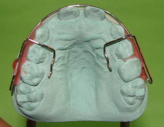 Ortodoncia Tecnica: primer klammt tipo I