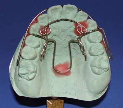 Ortodoncia Tecnica: primer klammt tipo I