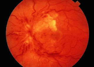 Retinopathy: Fundoscopy Hypertensive Retinopathy
