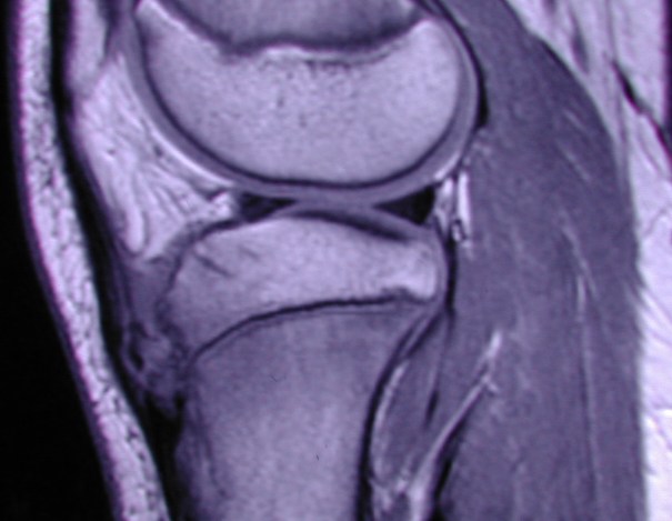 Lacey's MRI and CT pathology: Osgood-Schlatter Disease