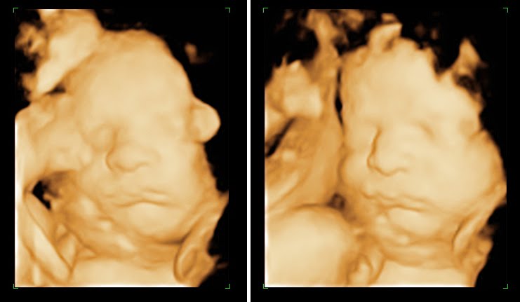 babyFLOCK: week 33: 3D ultrasound